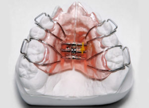 Appareil d'interception - Orthodontie enfant - Orthodontiste Bordeaux